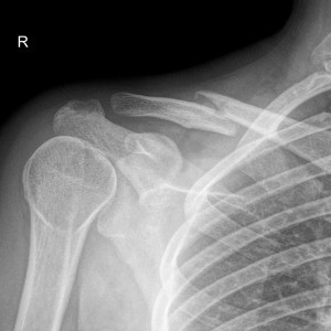 Radiografia Normal Da Clavicula Posicionamiento De Clavícula De Rayos